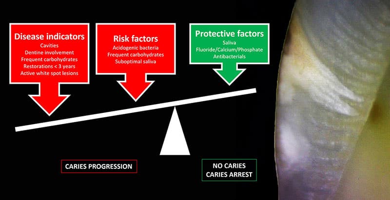 Clinical risk 1: Caries | Denplan